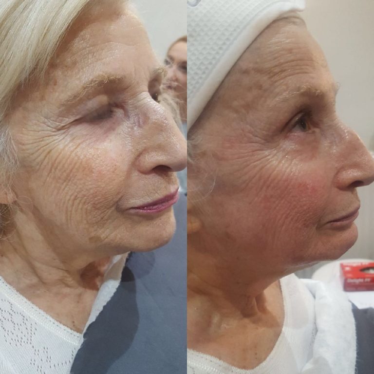 Geneo Super Facial – Eloise Beauty and Aesthetics